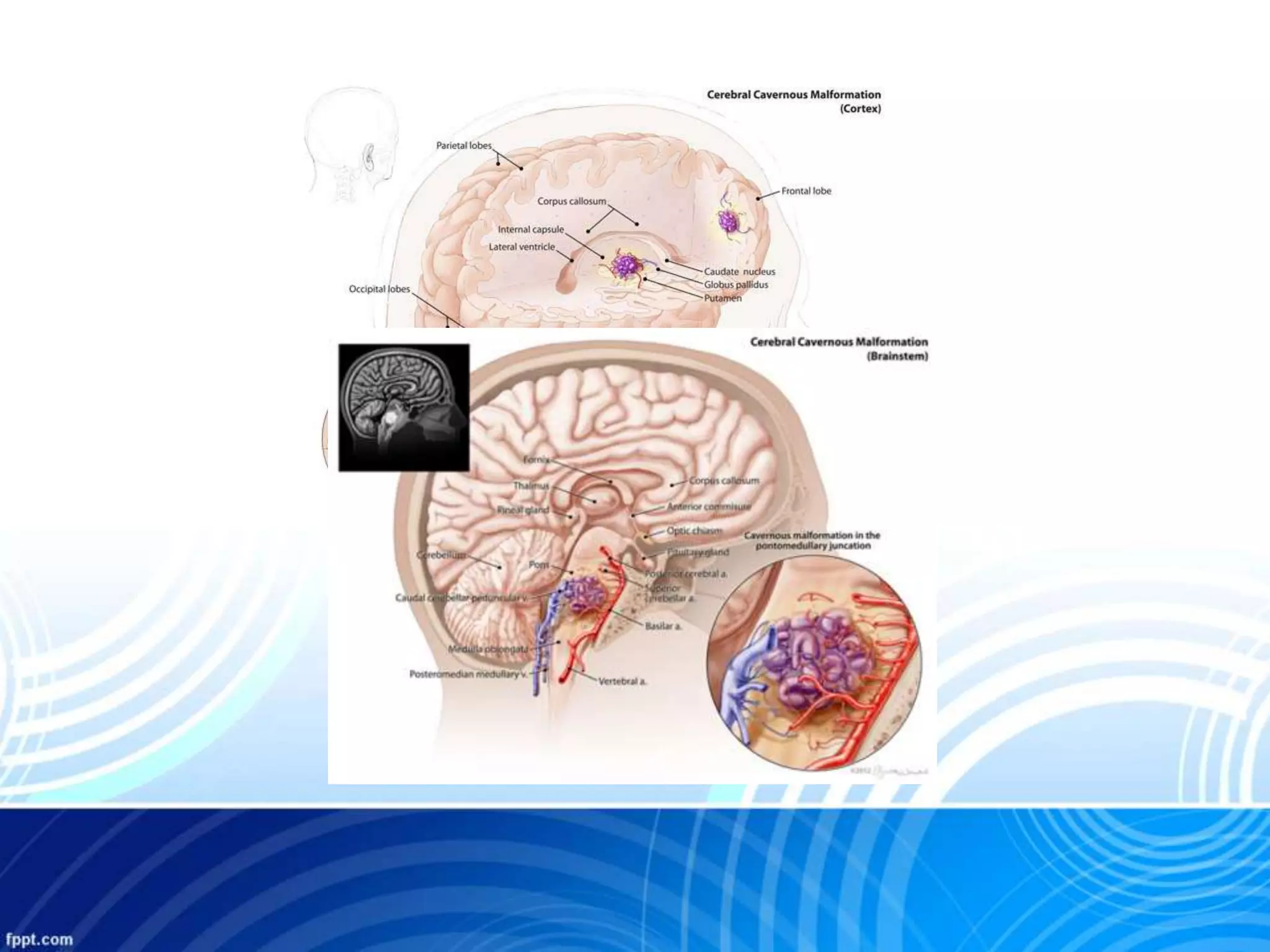 Dural arteriovenous fistula & AVM | PPTX
