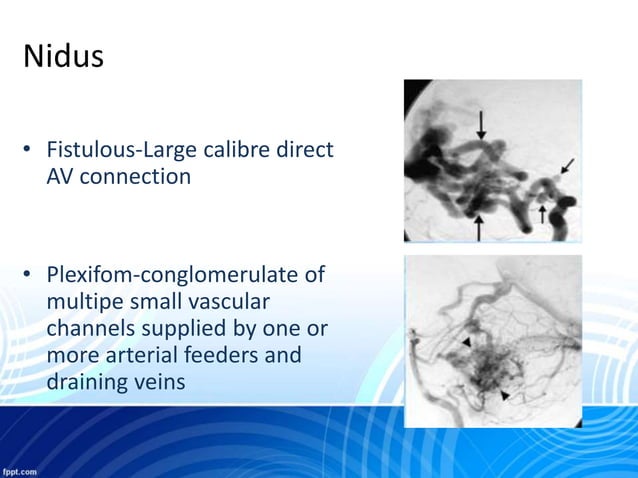 Dural arteriovenous fistula & AVM | PPTX | Blood Disorders | Diseases and Conditions