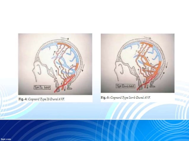Dural arteriovenous fistula & AVM | PPTX | Blood Disorders | Diseases ...