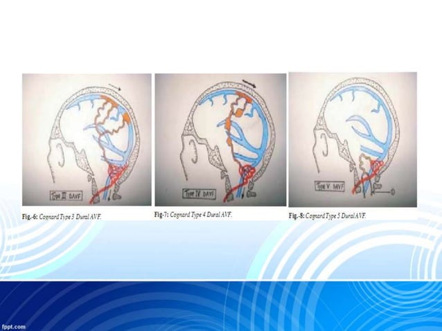 Dural arteriovenous fistula & AVM | PPTX | Blood Disorders | Diseases ...