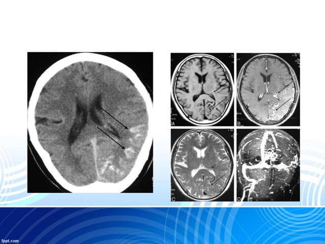 Dural arteriovenous fistula & AVM | PPTX | Blood Disorders | Diseases and Conditions