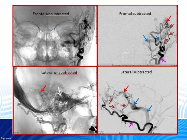Dural arteriovenous fistula & AVM | PPTX | Blood Disorders | Diseases ...