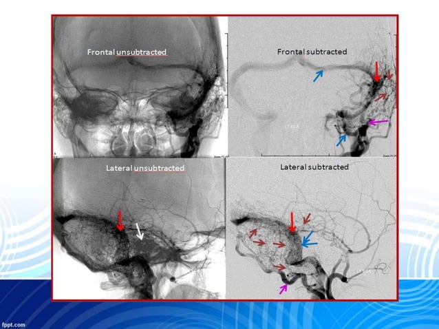 Dural arteriovenous fistula & AVM | PPTX | Blood Disorders | Diseases and Conditions