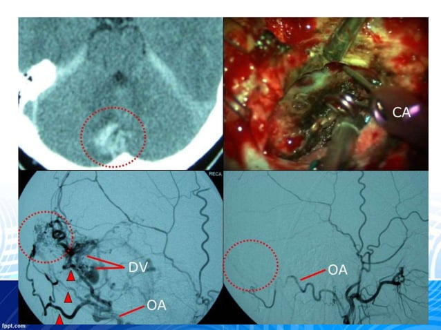 Dural arteriovenous fistula & AVM | PPTX | Blood Disorders | Diseases ...