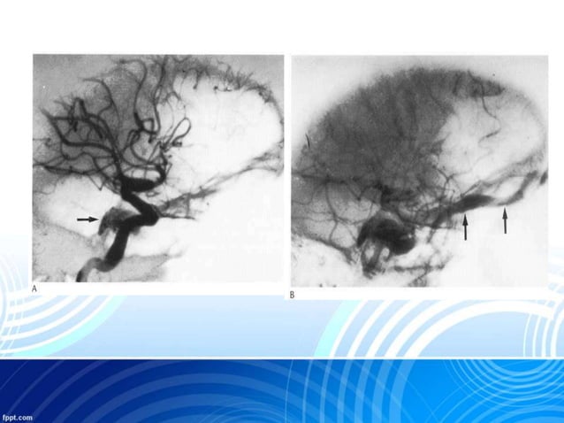 Dural arteriovenous fistula & AVM | PPTX | Blood Disorders | Diseases ...