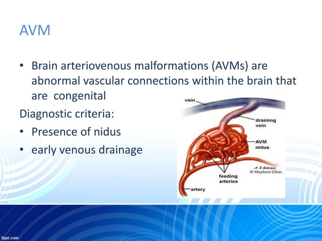 Dural arteriovenous fistula & AVM | PPTX | Blood Disorders | Diseases and Conditions