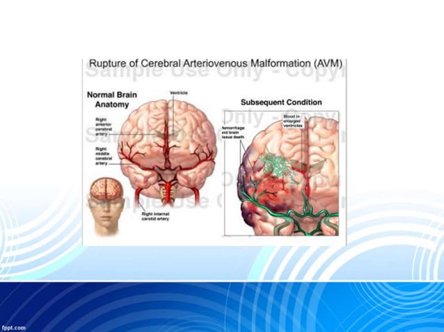 Dural arteriovenous fistula & AVM | PPT