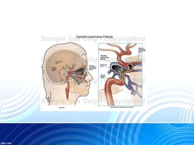 Dural arteriovenous fistula & AVM | PPTX | Blood Disorders | Diseases ...