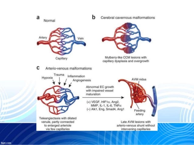 Dural arteriovenous fistula & AVM