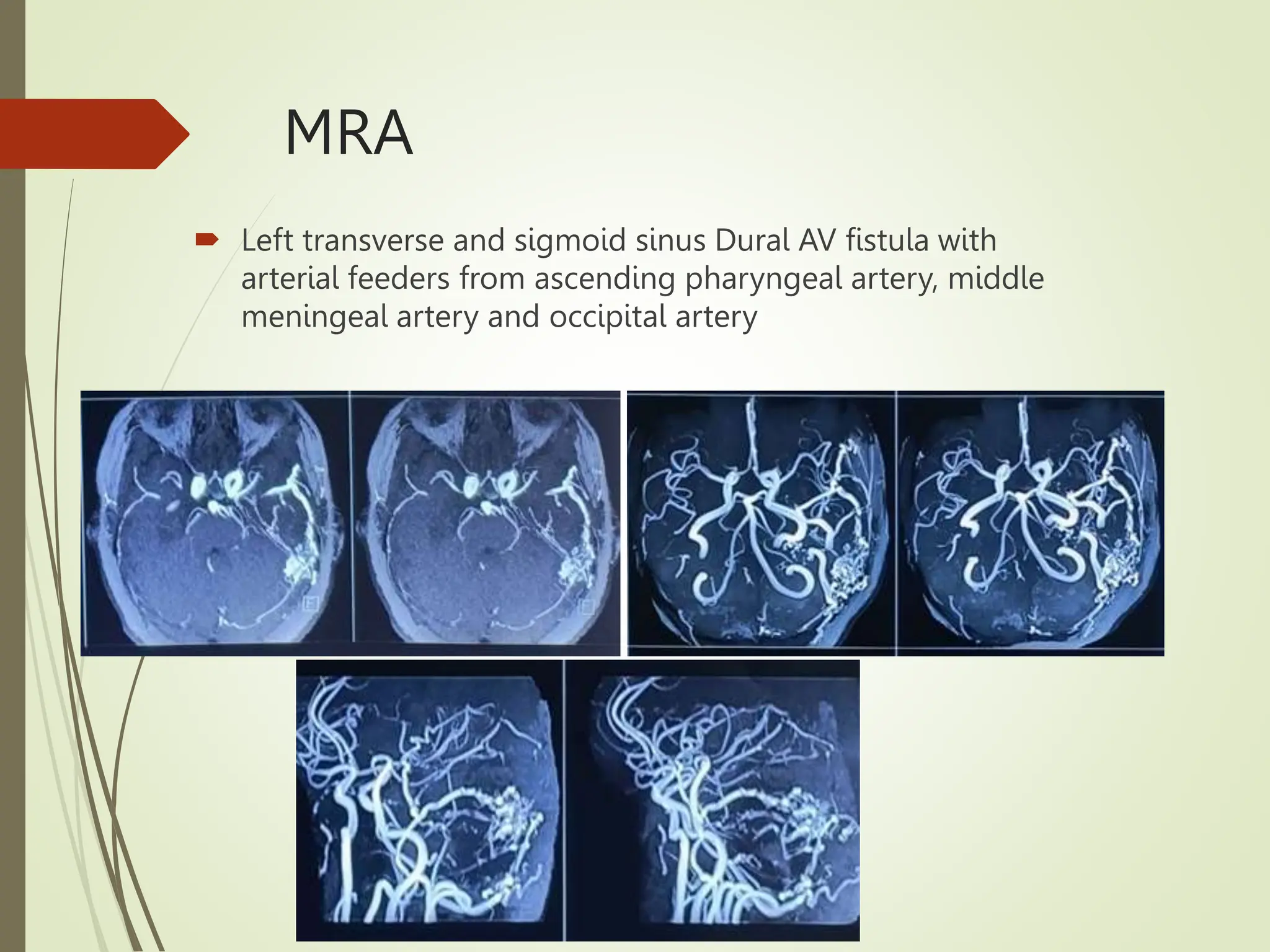 Sigmoid sinus Dural Arterio-Venous Fistula a Case Presentation .pptx