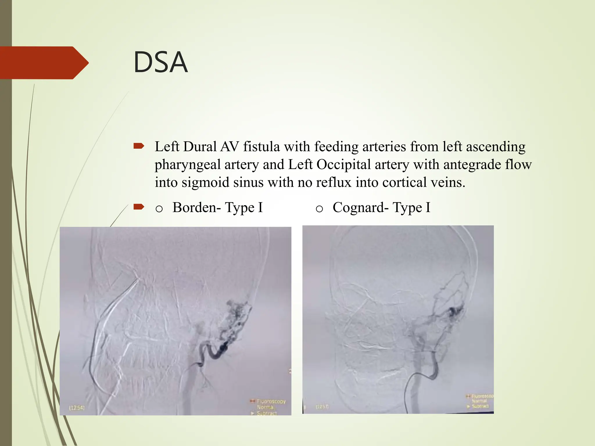 Sigmoid sinus Dural Arterio-Venous Fistula a Case Presentation .pptx