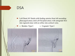 Sigmoid sinus Dural Arterio-Venous Fistula a Case Presentation .pptx
