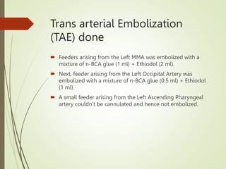 Sigmoid sinus Dural Arterio-Venous Fistula a Case Presentation .pptx