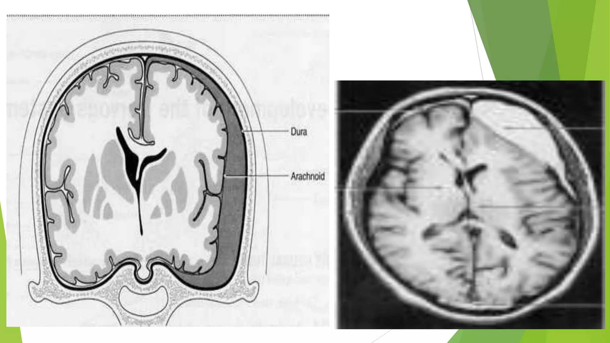 Dural folds and cavernous sinus | PPTX