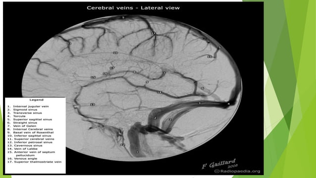 Dural folds and cavernous sinus | PPTX | Death, Injury, or Military ...