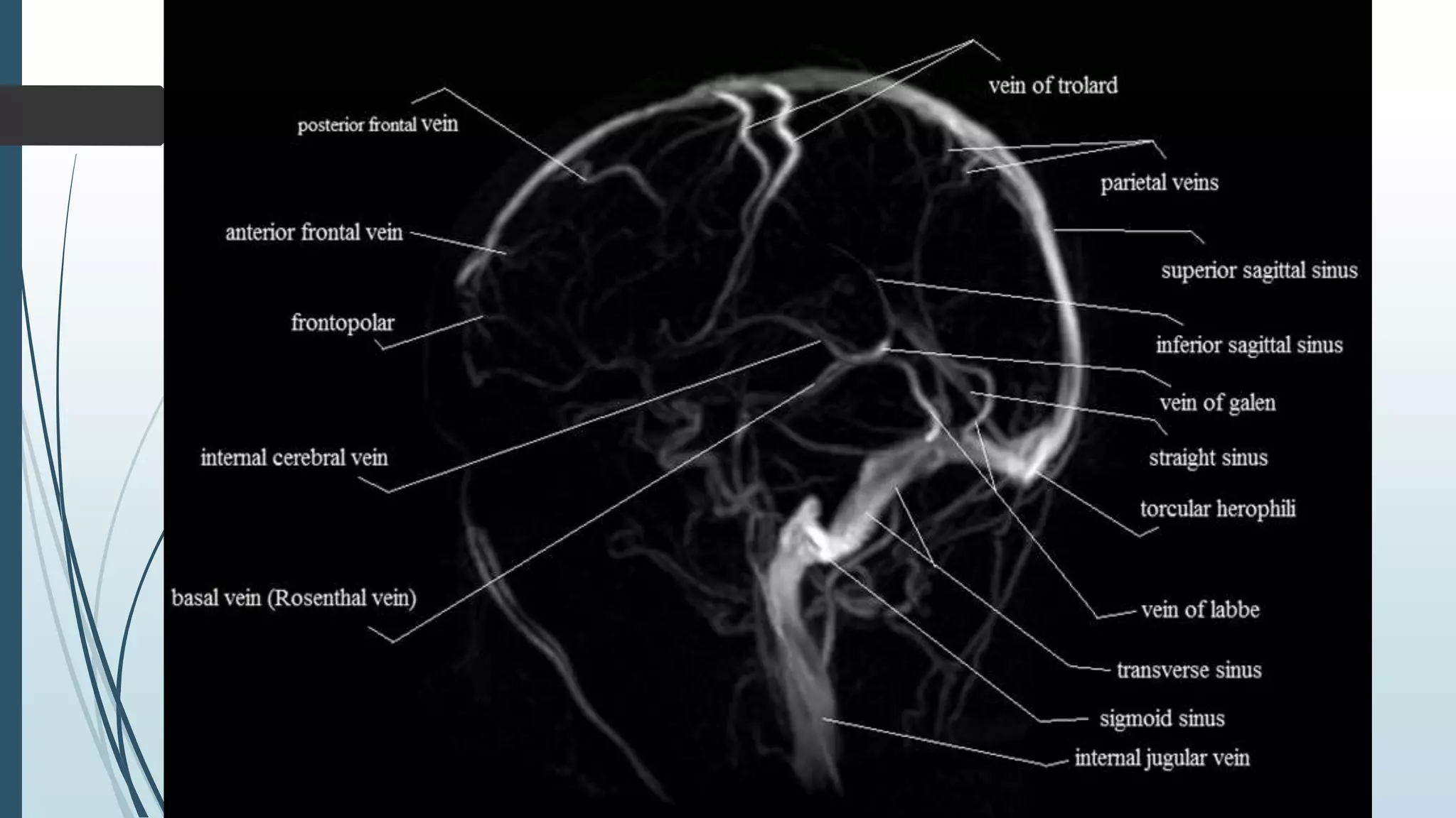 Dural venous sinus thrombosis for Radiology & Imaging | PPTX