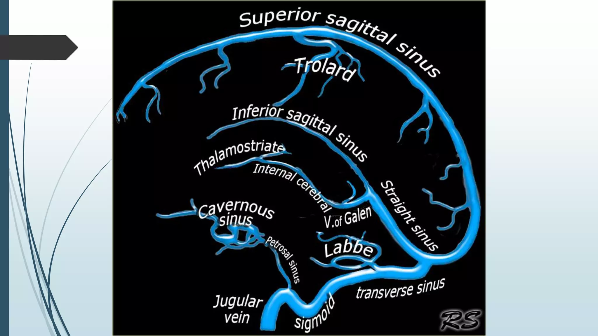 Dural venous sinus thrombosis for Radiology & Imaging | PPTX