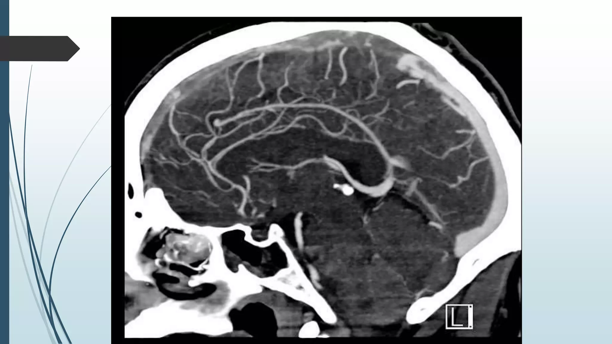 Dural venous sinus thrombosis for Radiology & Imaging | PPTX
