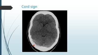 Dural venous sinus thrombosis for Radiology & Imaging | PPTX