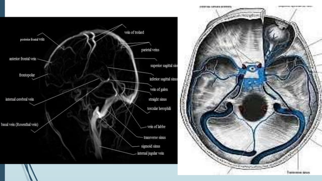 Dural venous sinus thrombosis for Radiology & Imaging