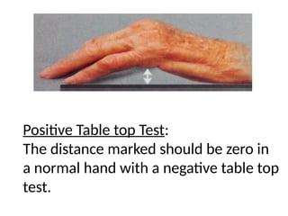 Duyptren contracture WITH management measures | PPTX