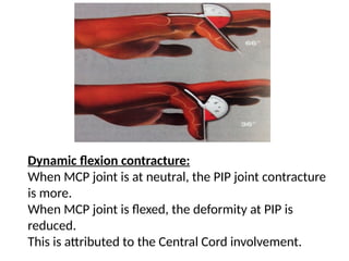 Duyptren contracture WITH management measures | PPTX