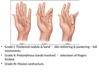 Duyptren contracture WITH management measures | PPTX