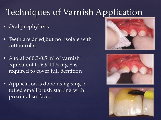 Dental Varnish