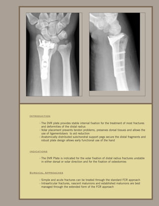Dvr digital radius | PDF