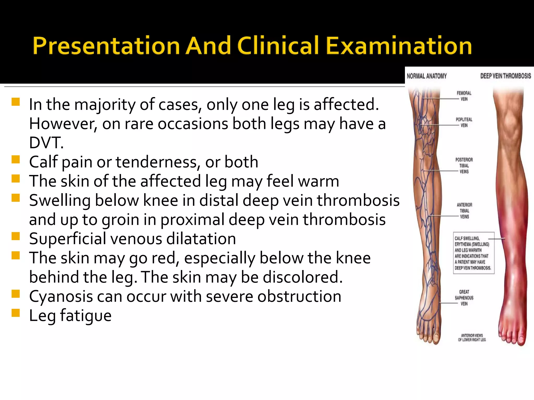 Dvt Deep Venous Thrombosis | PPT