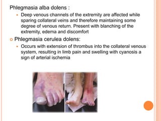 Phlegmasia Cerulea Dolens