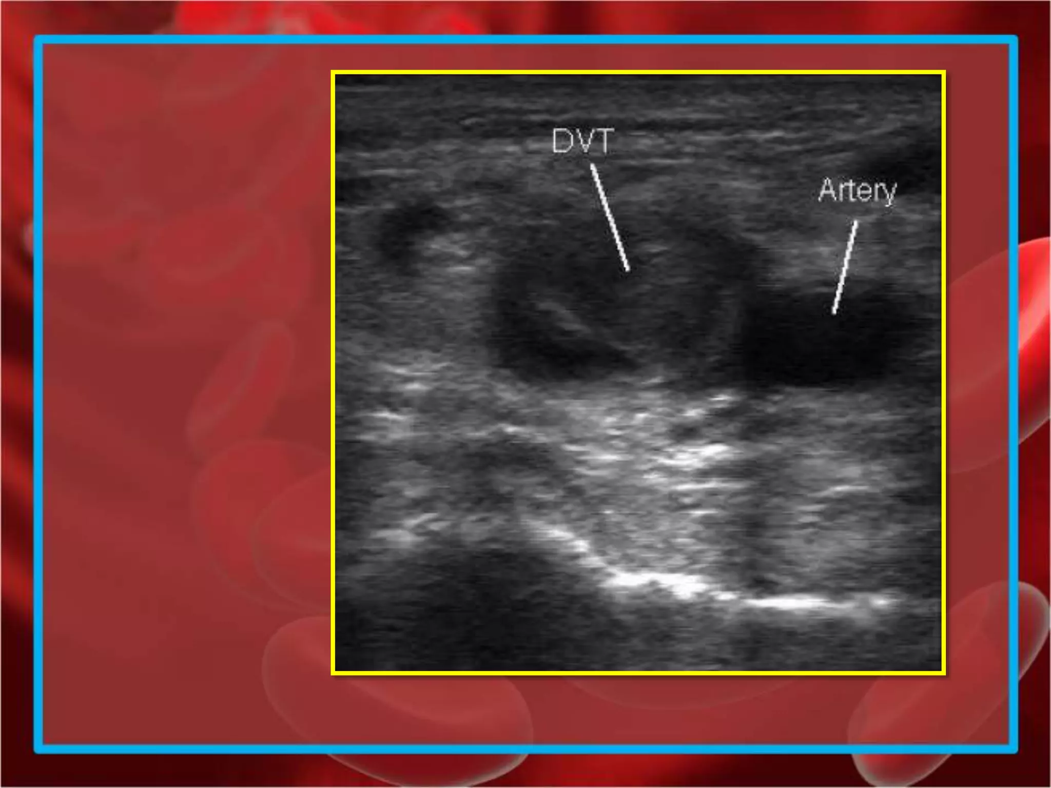DVT.. Deep vein thrombosis. | PPTX