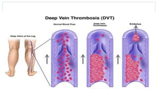 DEEP VEIN THROMBOSIS | PPTX