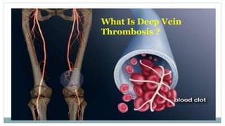 DEEP VEIN THROMBOSIS | PPTX