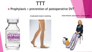 Dvt | PPT