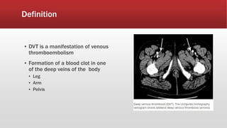 DVT | PPTX