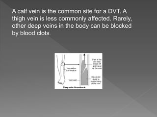 DVT.pptx