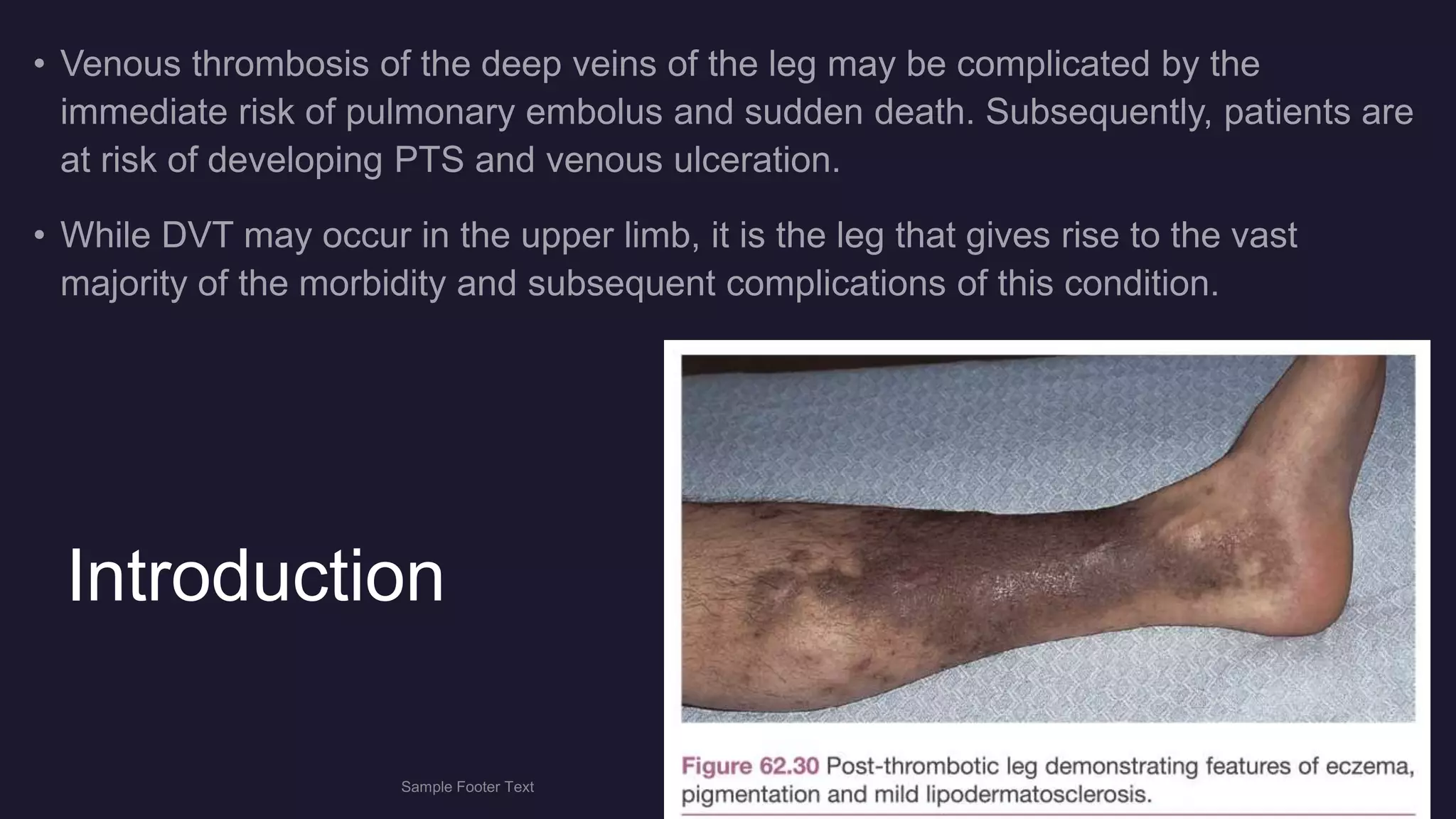 DVT( Deep Vein Thrombosis) | PPT