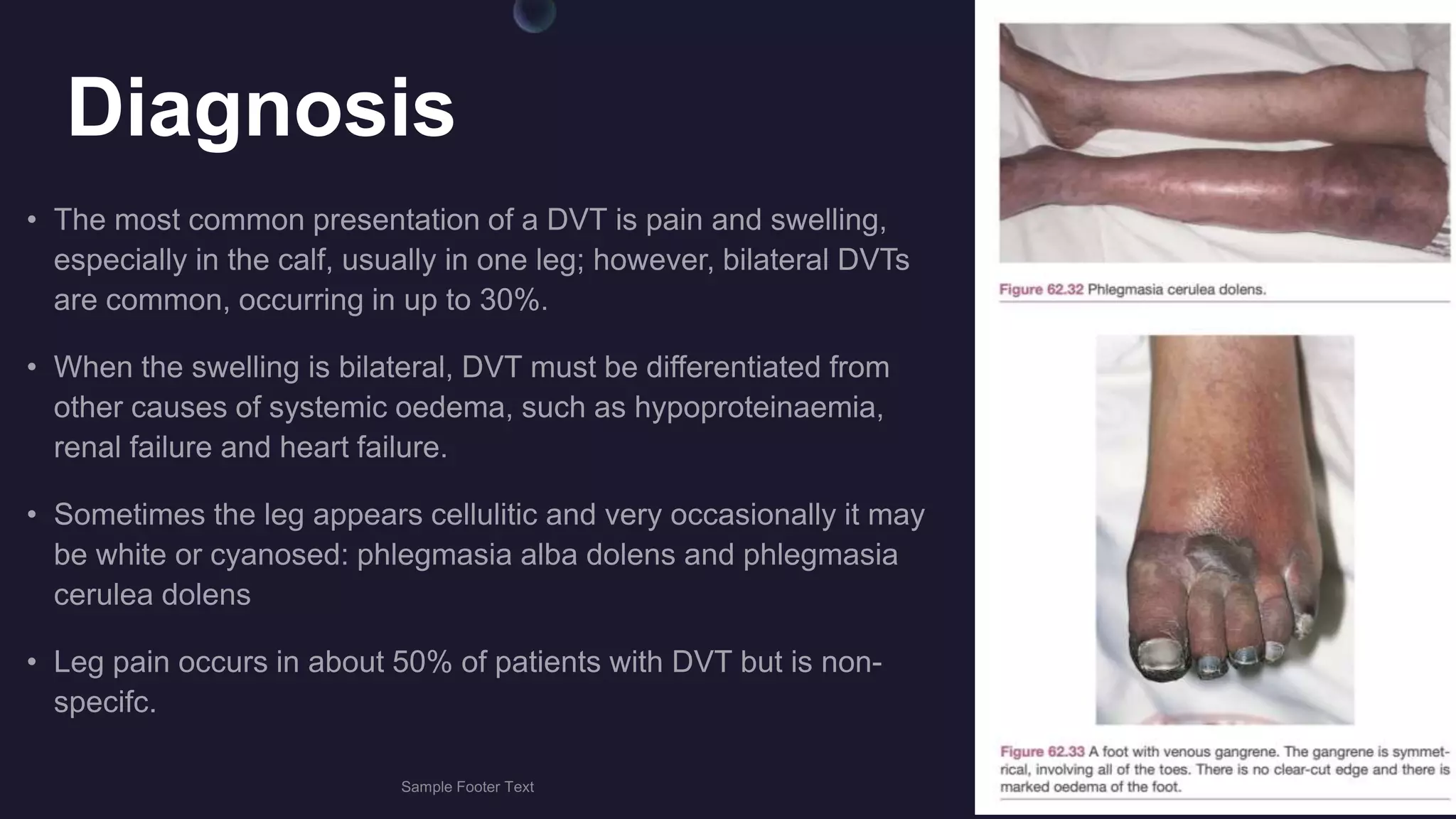 DVT( Deep Vein Thrombosis) | PPT