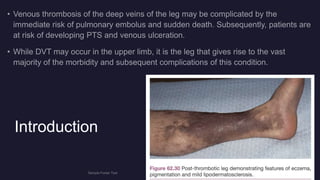 DVT( Deep Vein Thrombosis) | PPT