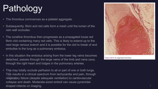 DVT( Deep Vein Thrombosis) | PPT