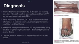 DVT( Deep Vein Thrombosis) | PPTX
