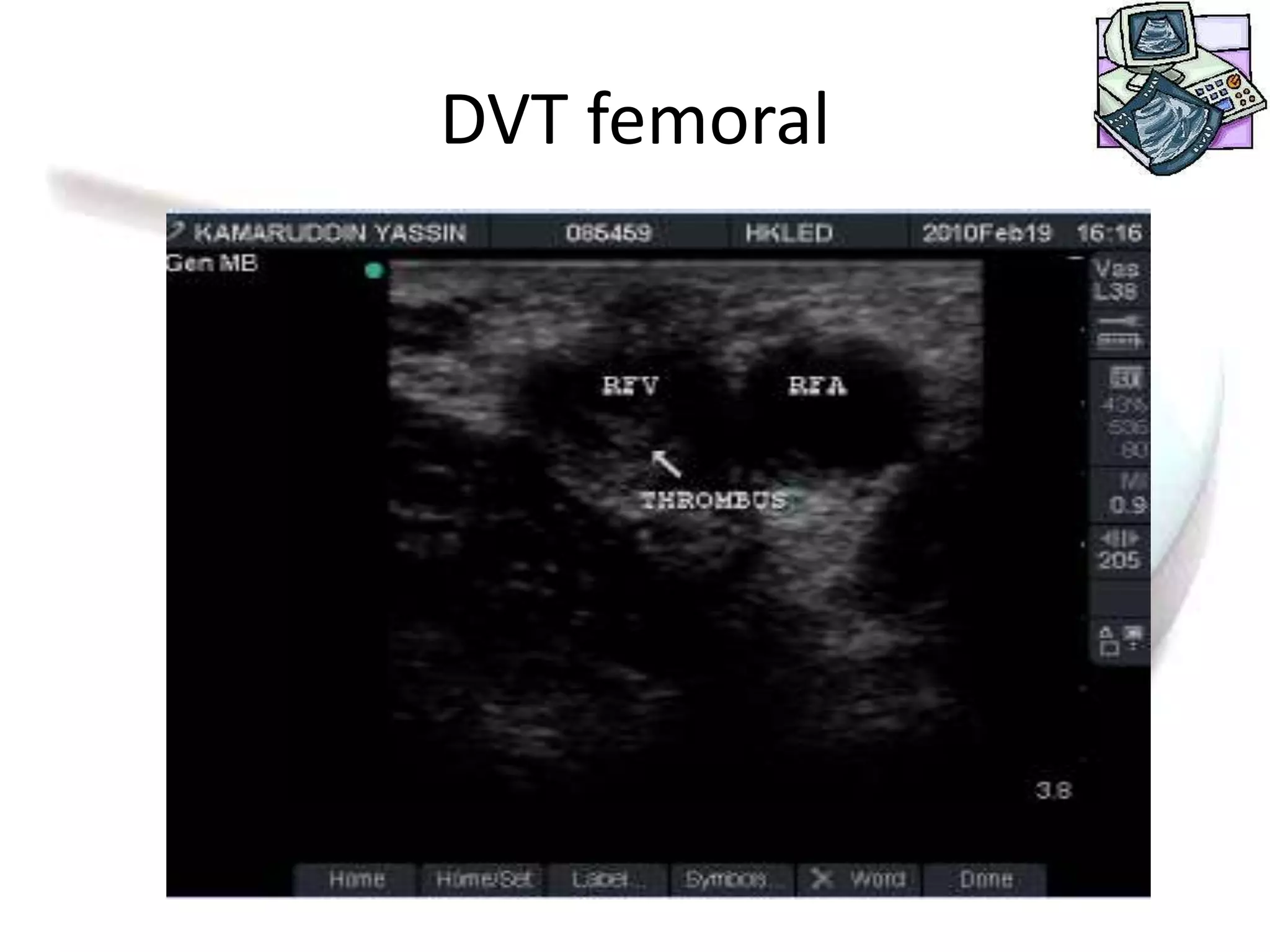 DEEP VEIN THROMBOSIS | PPTX