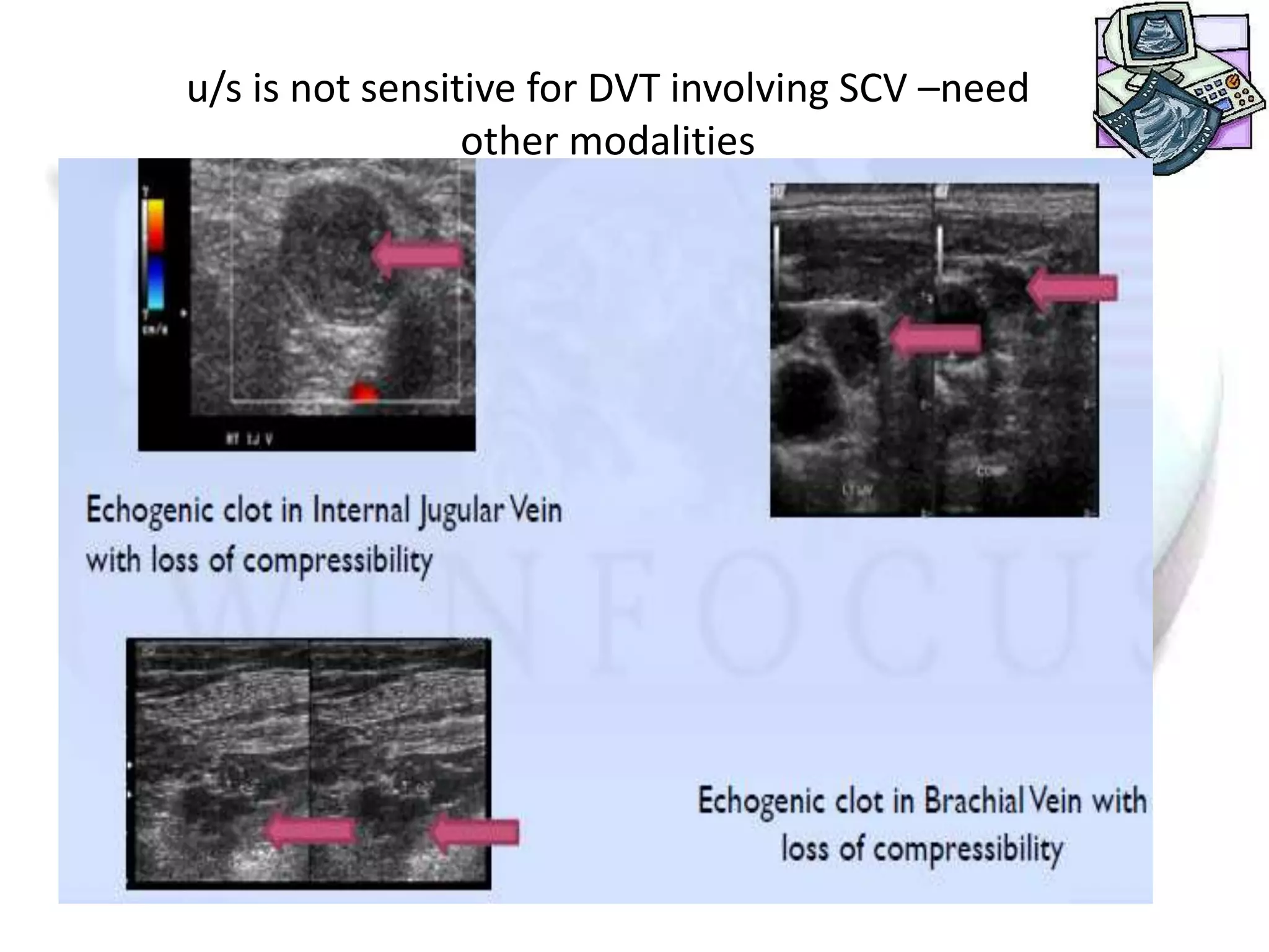 DEEP VEIN THROMBOSIS | PPTX