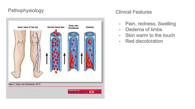 Deep vein thrombosis, etiology, diagnosis | PDF