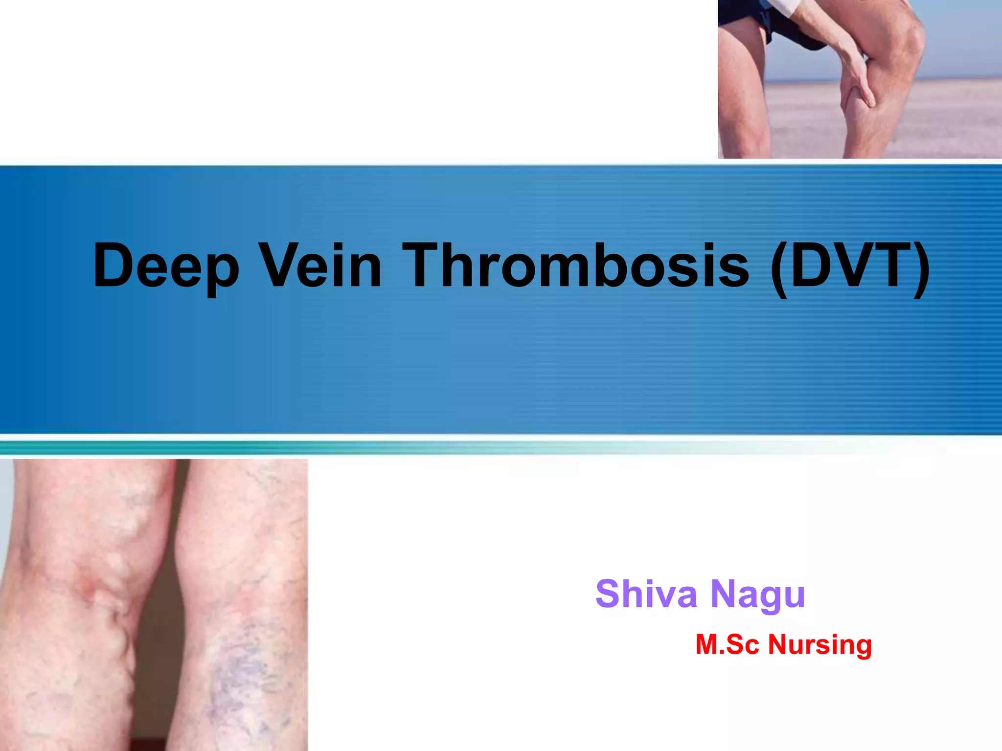 DEEP VEIN THROMBOSIS DVT | PPT