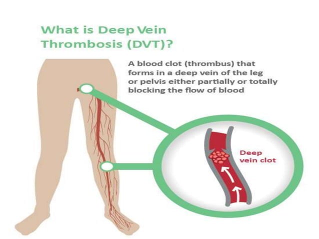 DEEP VEIN THROMBOSIS DVT | PPT