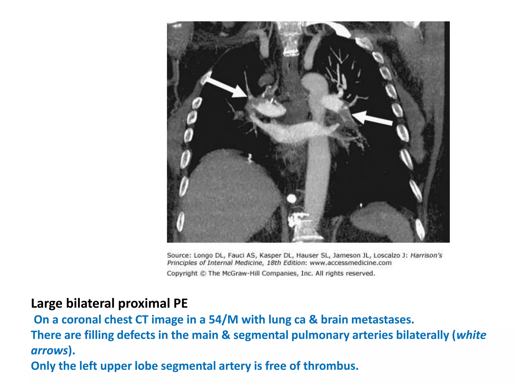 dvt and Pulmonary Thromboembolism 43.pptx | Blood Disorders | Diseases ...