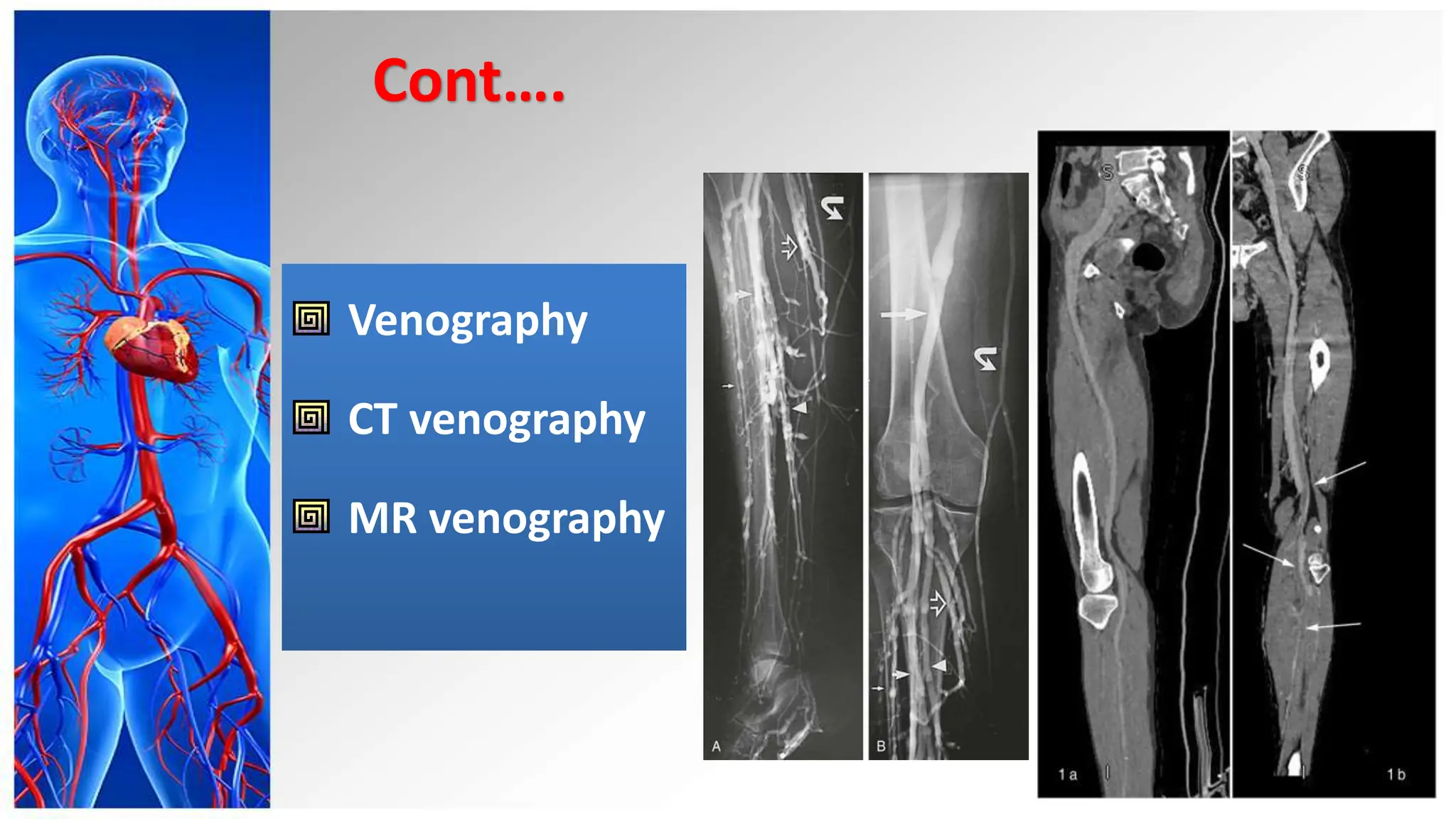 DVT and Vericose Vein and it causes and treatment | PPTX