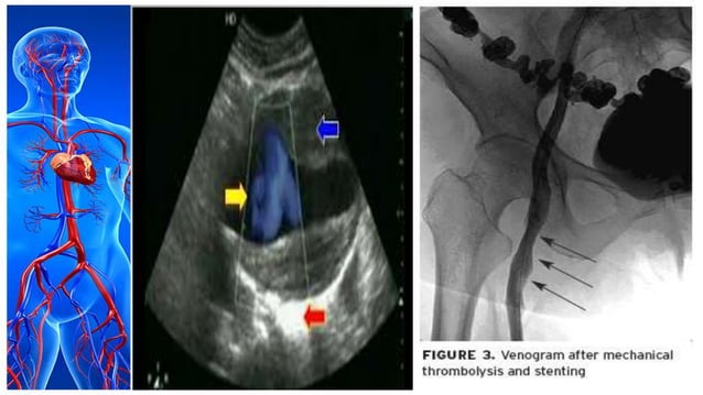 DVT and Vericose Vein and it causes and treatment | PPT